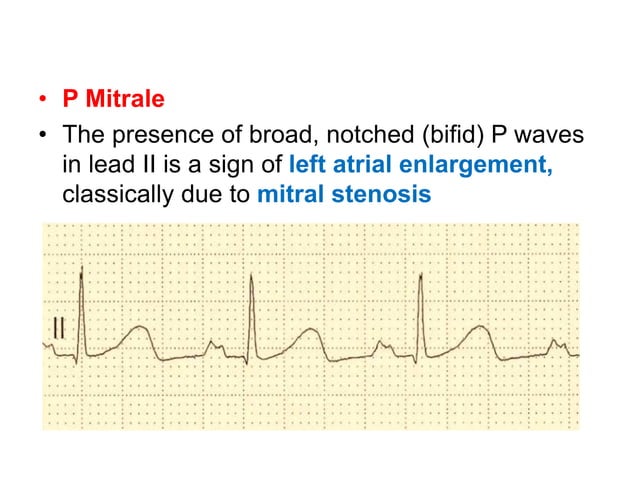 P WAVE IN ECG,ABNORMALITIES OF P WAVE IN ECG | PPTX | Heart and Cardiovascular Diseases ...