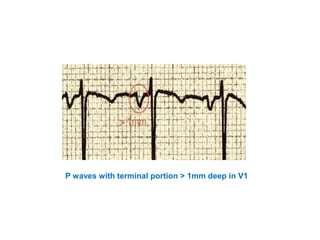 P WAVE IN ECG,ABNORMALITIES OF P WAVE IN ECG | PPTX