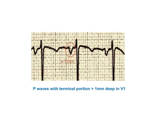 P WAVE IN ECG,ABNORMALITIES OF P WAVE IN ECG | PPTX | Heart and ...