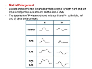 P WAVE IN ECG,ABNORMALITIES OF P WAVE IN ECG | PPTX
