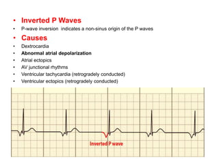 P WAVE IN ECG,ABNORMALITIES OF P WAVE IN ECG | PPTX