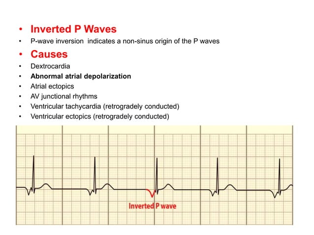 P WAVE IN ECG,ABNORMALITIES OF P WAVE IN ECG | PPTX | Heart and Cardiovascular Diseases ...