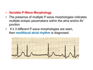 P WAVE IN ECG,ABNORMALITIES OF P WAVE IN ECG | PPTX