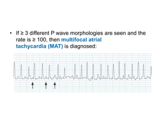 P WAVE IN ECG,ABNORMALITIES OF P WAVE IN ECG | PPTX