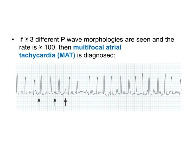 P WAVE IN ECG,ABNORMALITIES OF P WAVE IN ECG | PPTX | Heart and Cardiovascular Diseases ...