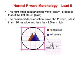 P WAVE IN ECG,ABNORMALITIES OF P WAVE IN ECG | PPTX