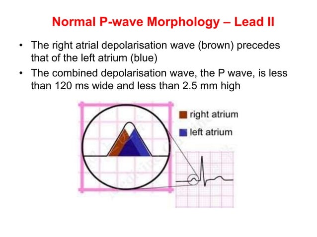 P WAVE IN ECG,ABNORMALITIES OF P WAVE IN ECG | PPTX | Heart and Cardiovascular Diseases ...