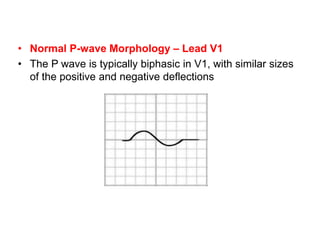 P WAVE IN ECG,ABNORMALITIES OF P WAVE IN ECG | PPTX