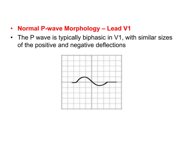 P WAVE IN ECG,ABNORMALITIES OF P WAVE IN ECG | PPTX | Heart and ...