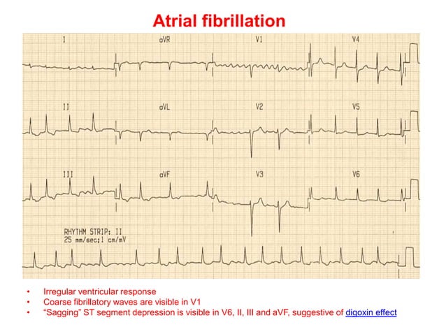 P WAVE IN ECG,ABNORMALITIES OF P WAVE IN ECG | PPTX | Heart and Cardiovascular Diseases ...