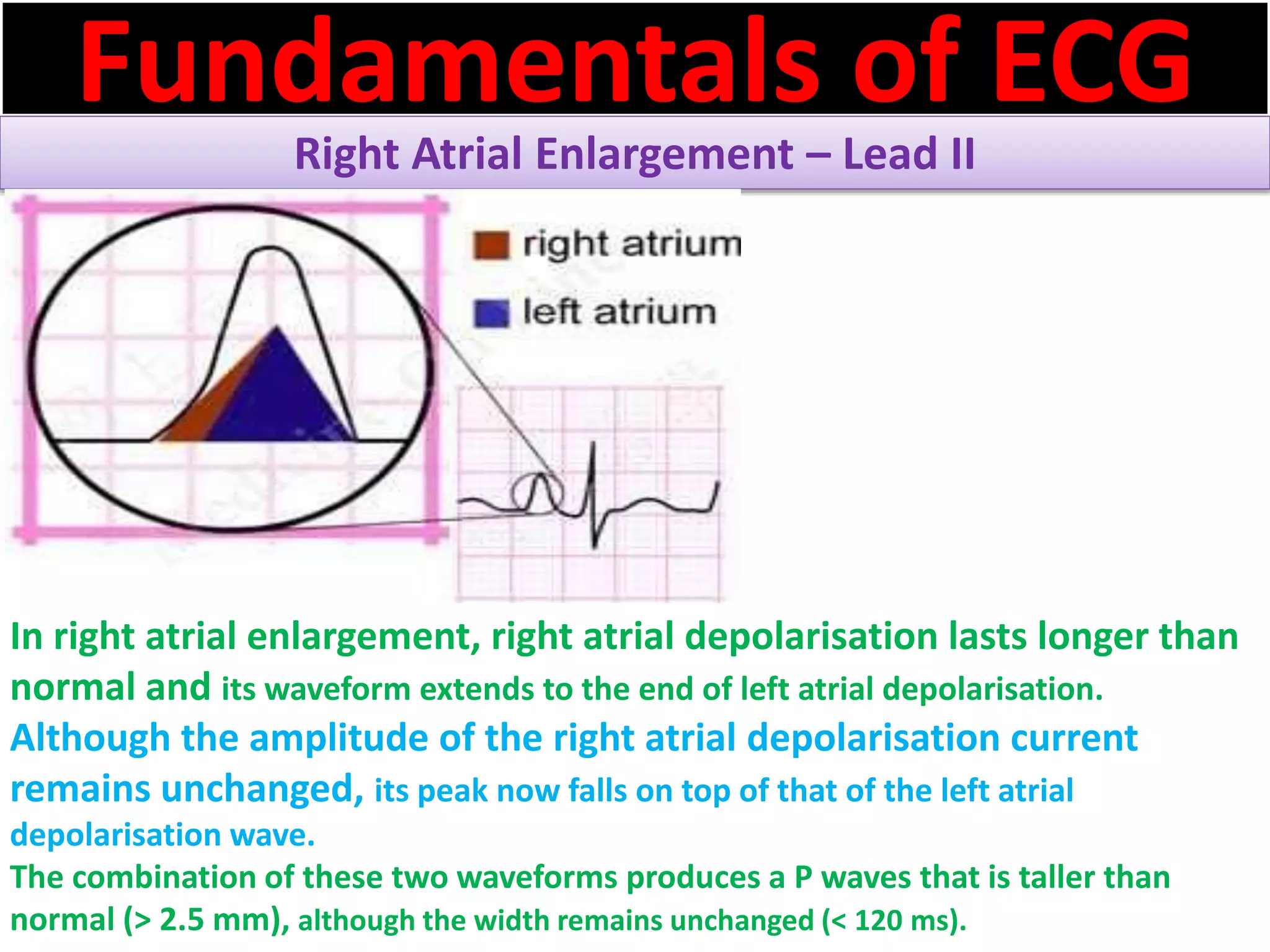 P wave abnormalities in ECG | PPSX