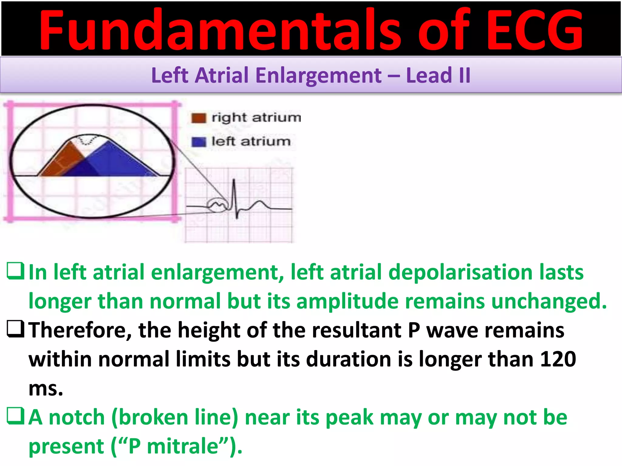 P wave abnormalities in ECG | PPSX