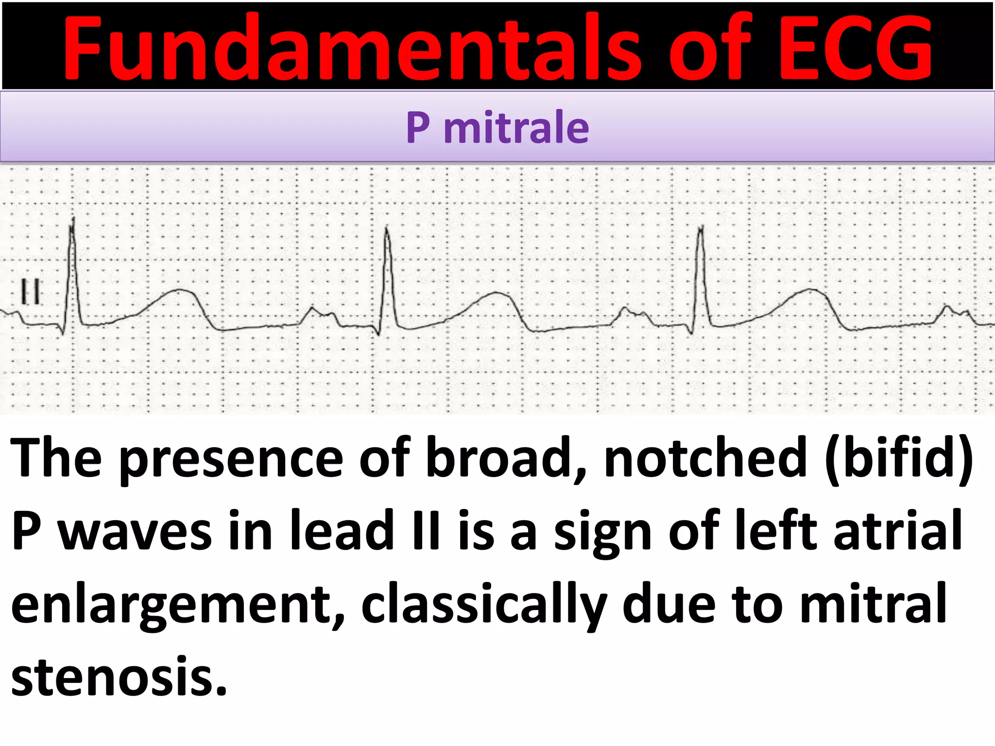 P wave abnormalities in ECG | PPSX