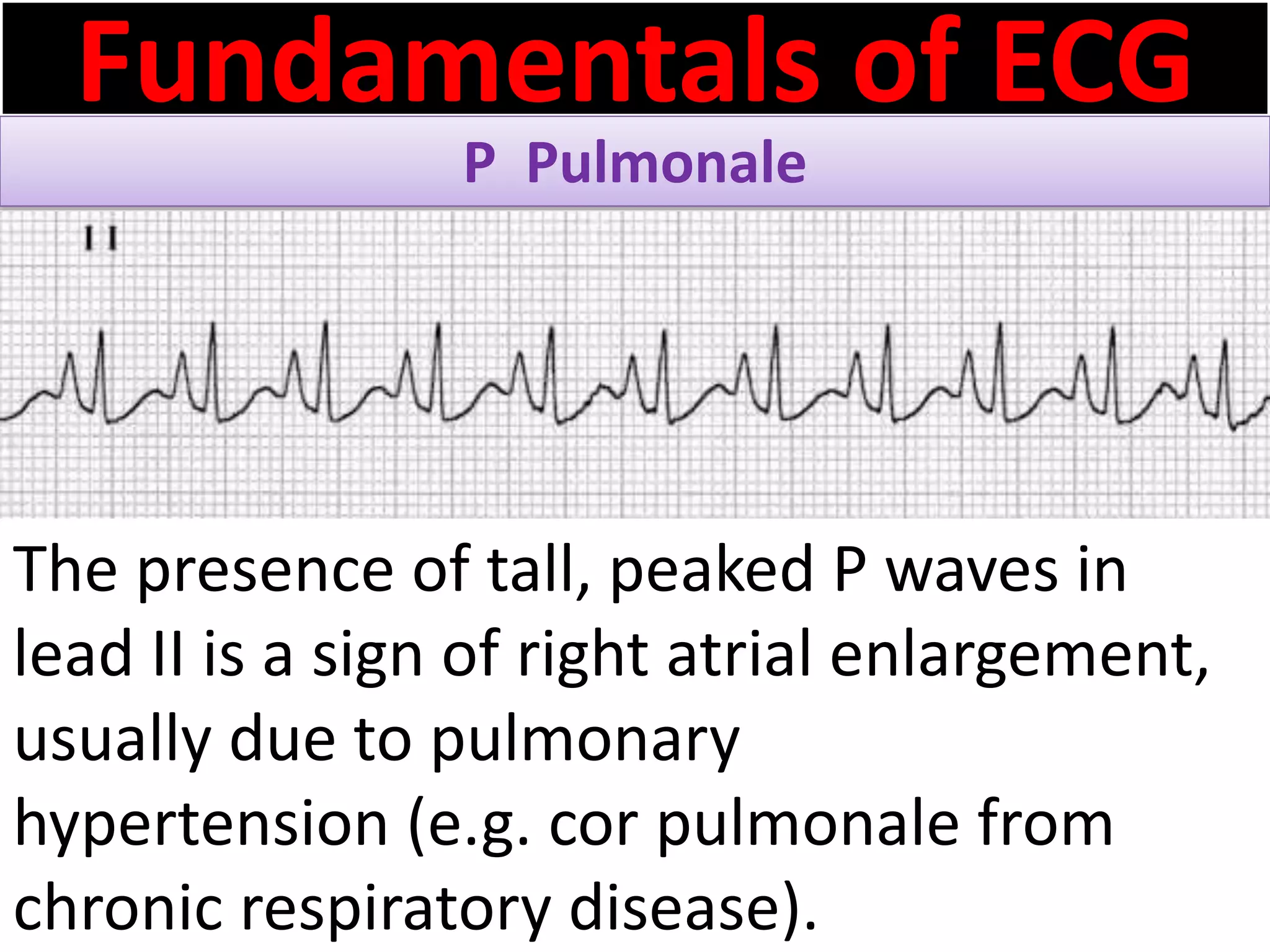 P wave abnormalities in ECG | PPSX