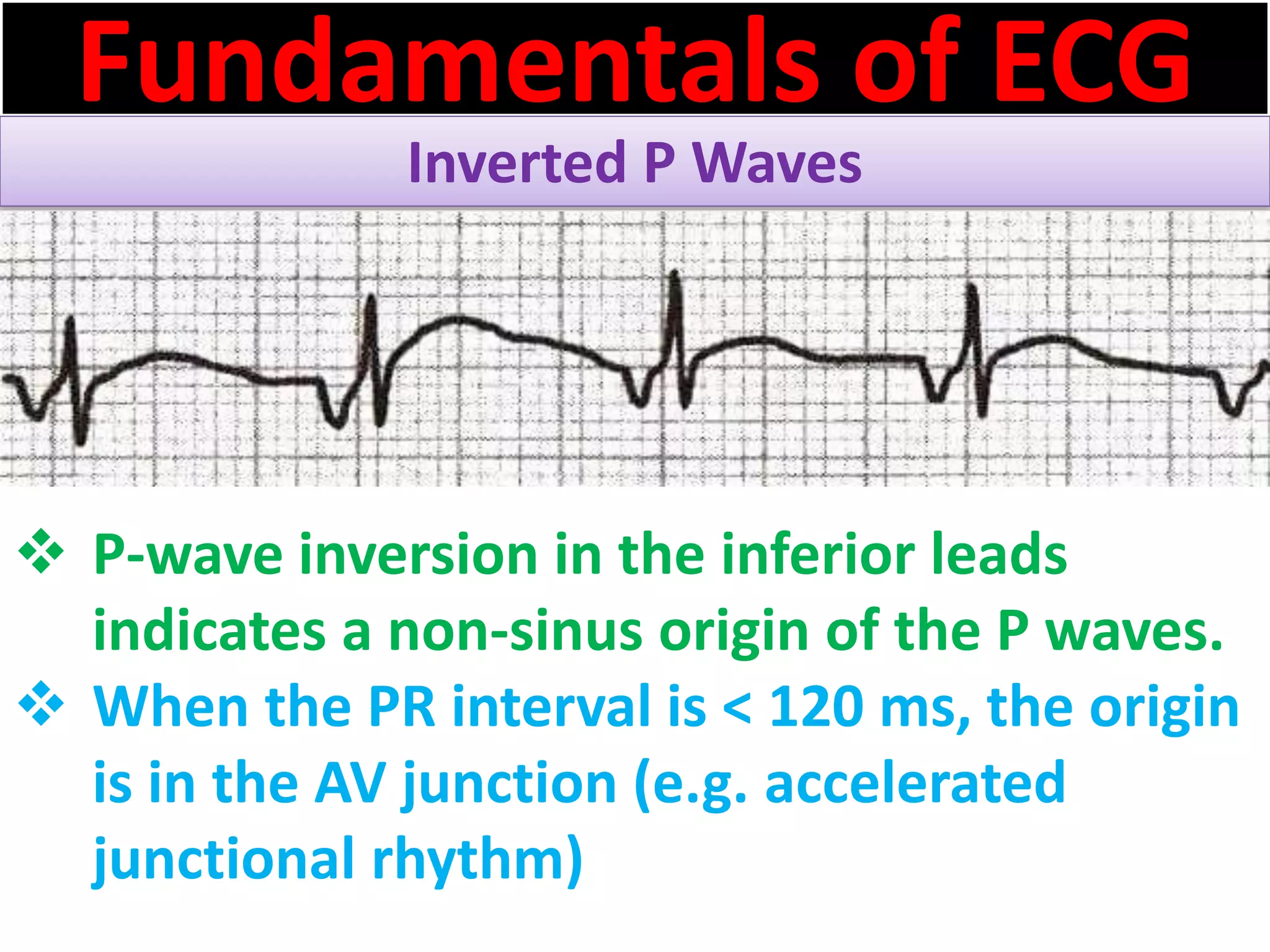P wave abnormalities in ECG | PPSX