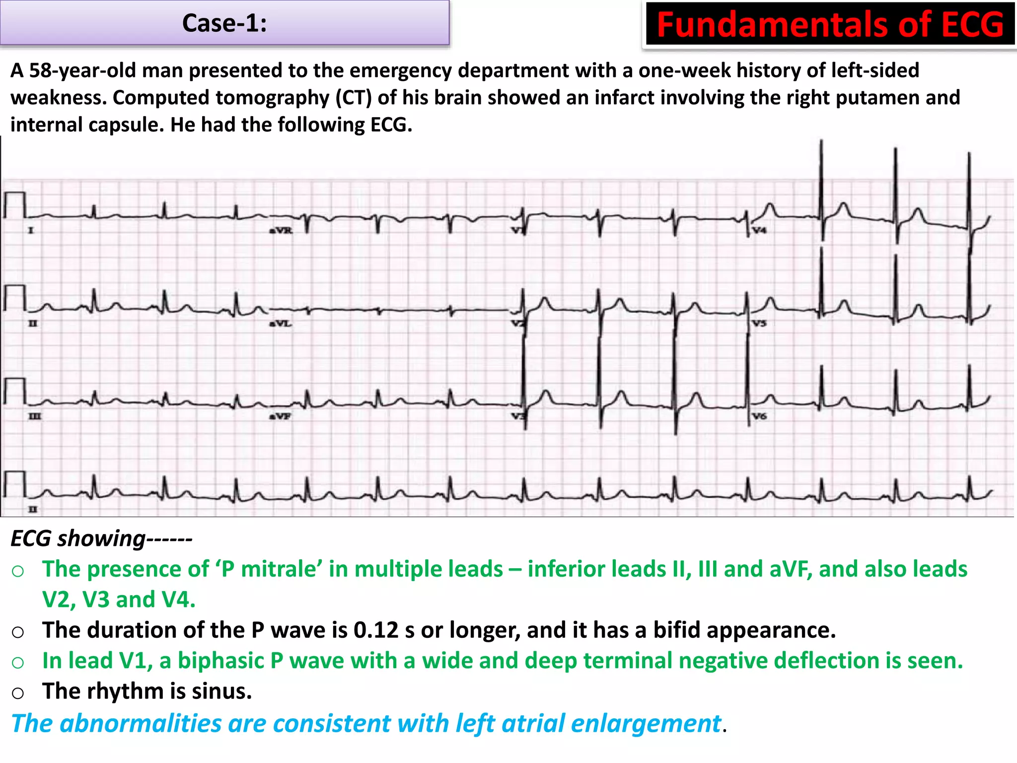 P wave abnormalities in ECG | PPSX