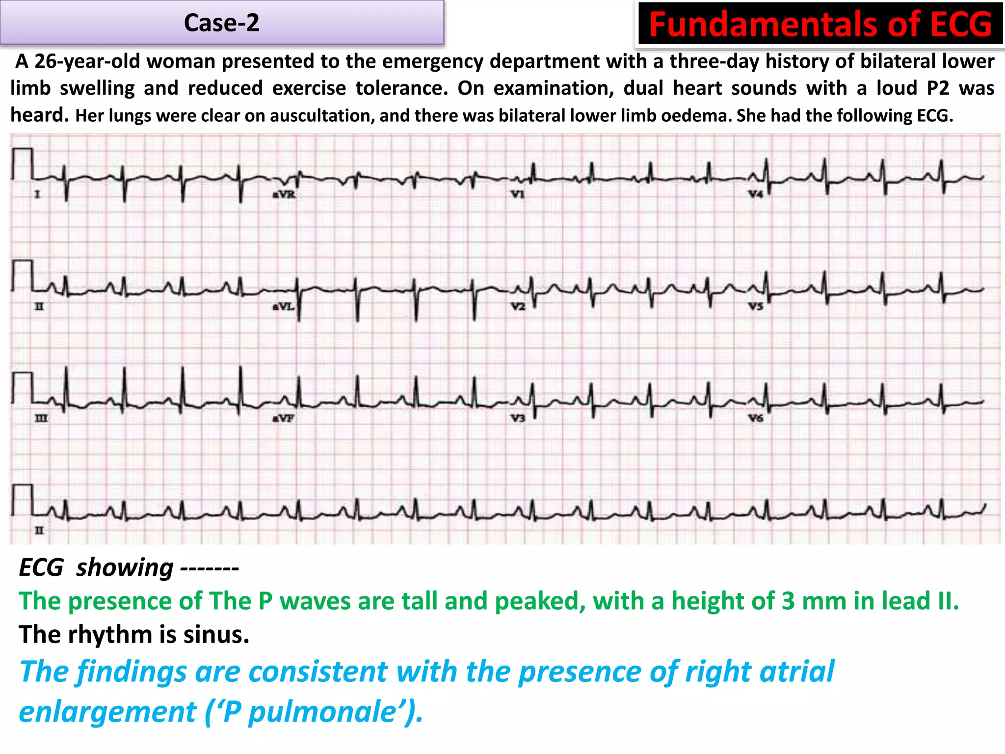 P wave abnormalities in ECG | PPSX