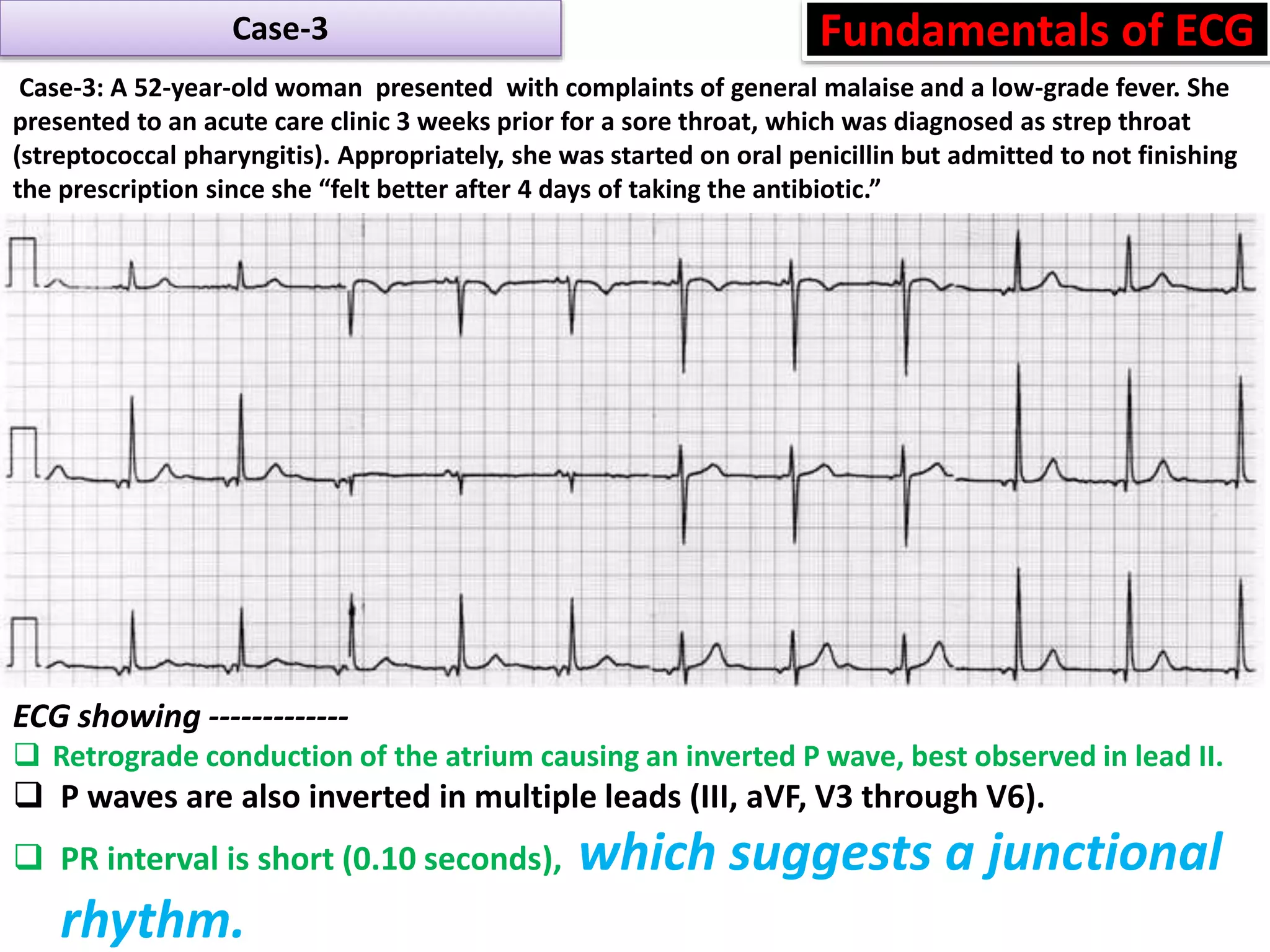 P wave abnormalities in ECG | PPSX