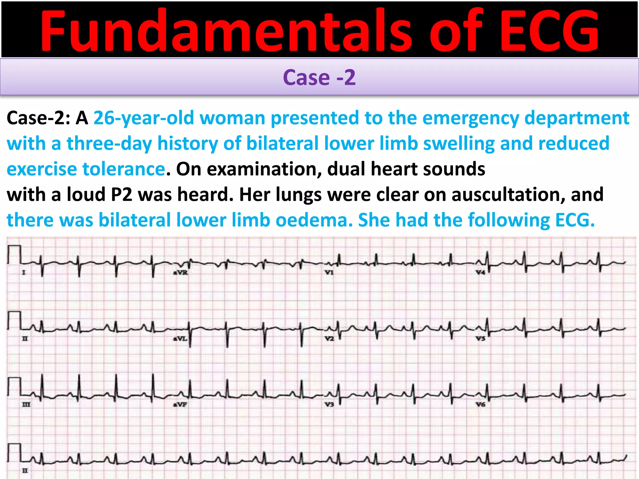 P wave abnormalities in ECG | PPSX