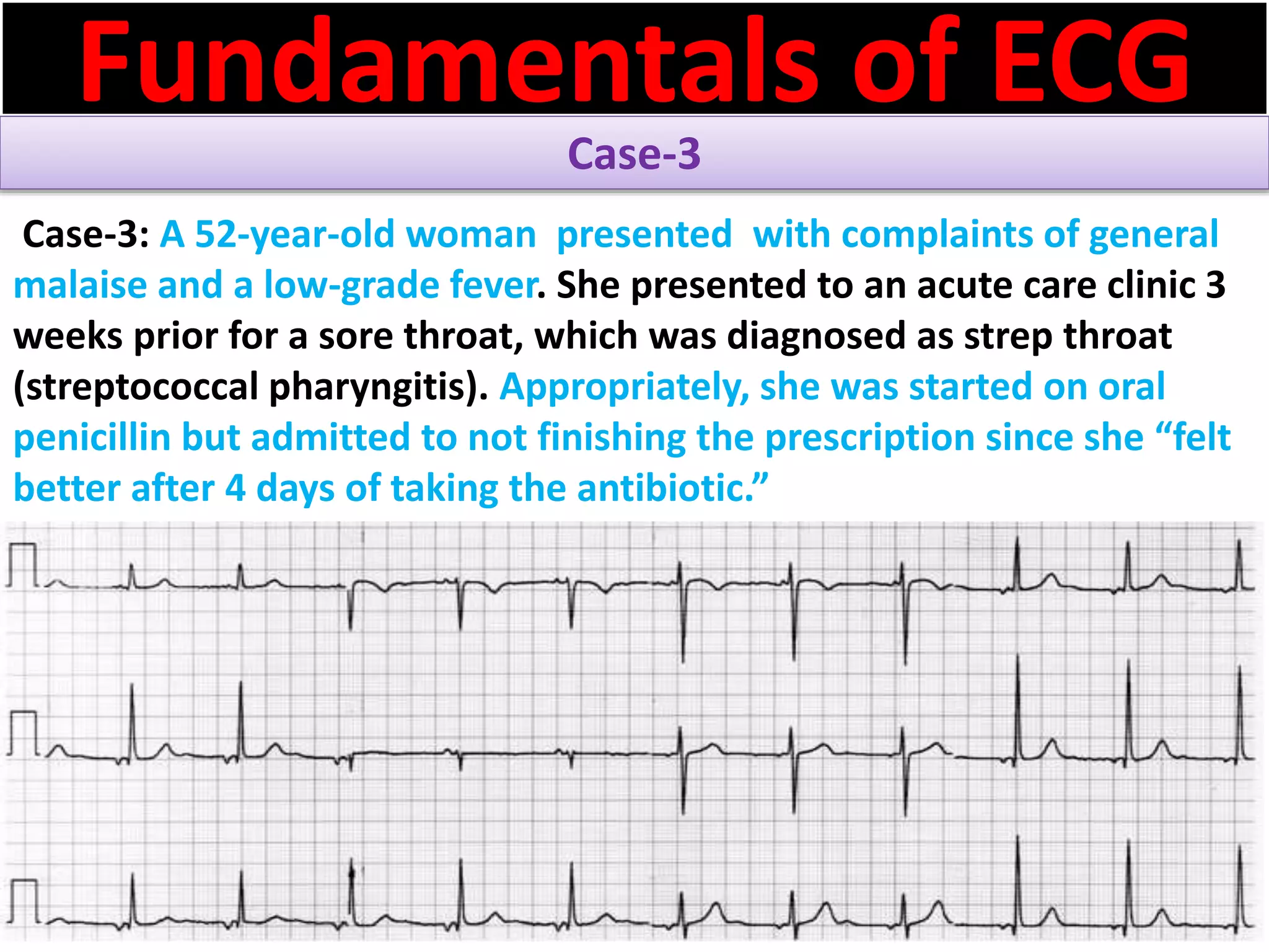 P wave abnormalities in ECG | PPSX