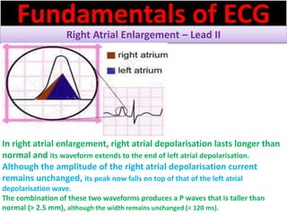 P wave abnormalities in ECG | PPSX