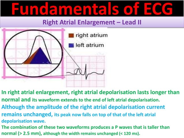 P wave abnormalities in ECG | PPSX | Heart and Cardiovascular Diseases ...