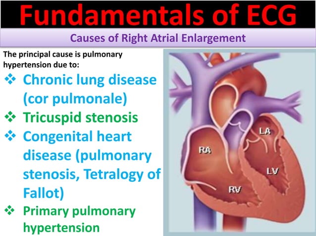 P wave abnormalities in ECG | PPSX | Heart and Cardiovascular Diseases | Diseases and Conditions