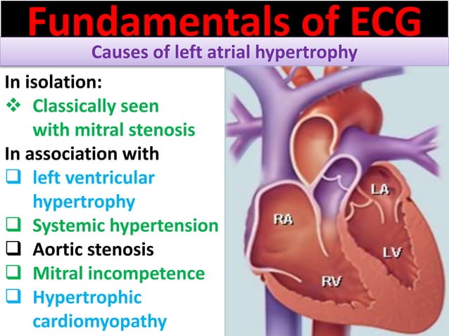 P wave abnormalities in ECG | PPSX | Heart and Cardiovascular Diseases | Diseases and Conditions