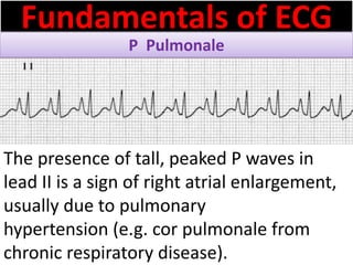 P wave abnormalities in ECG | PPSX