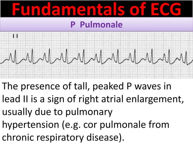 P wave abnormalities in ECG | PPSX | Heart and Cardiovascular Diseases | Diseases and Conditions