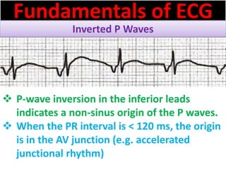 P wave abnormalities in ECG | PPSX