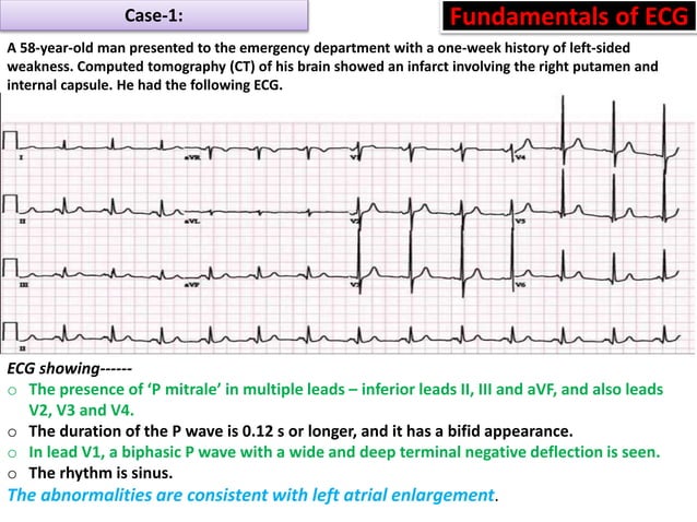 P wave abnormalities in ECG | PPSX | Heart and Cardiovascular Diseases ...