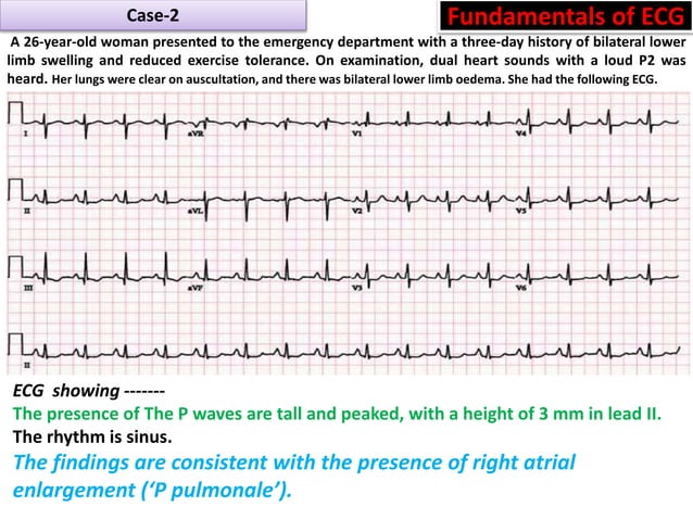 P wave abnormalities in ECG | PPSX | Heart and Cardiovascular Diseases | Diseases and Conditions