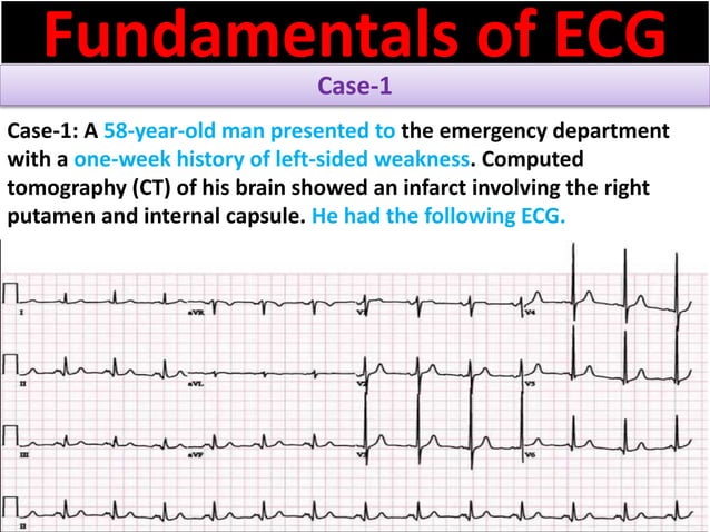 P wave abnormalities in ECG | PPSX | Heart and Cardiovascular Diseases | Diseases and Conditions