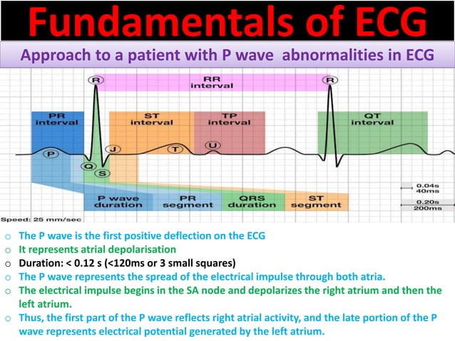 P wave abnormalities in ECG