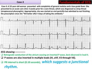 Junctional Rhythm Inverted P Wave