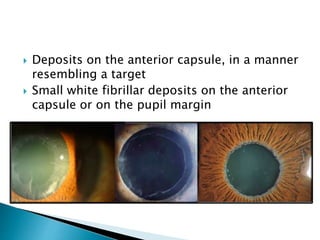 Pseudoexfoliative Glaucoma