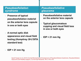 pseudoexfoliative glaucoma | PPTX