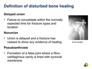 Delayed mal non union | PPT