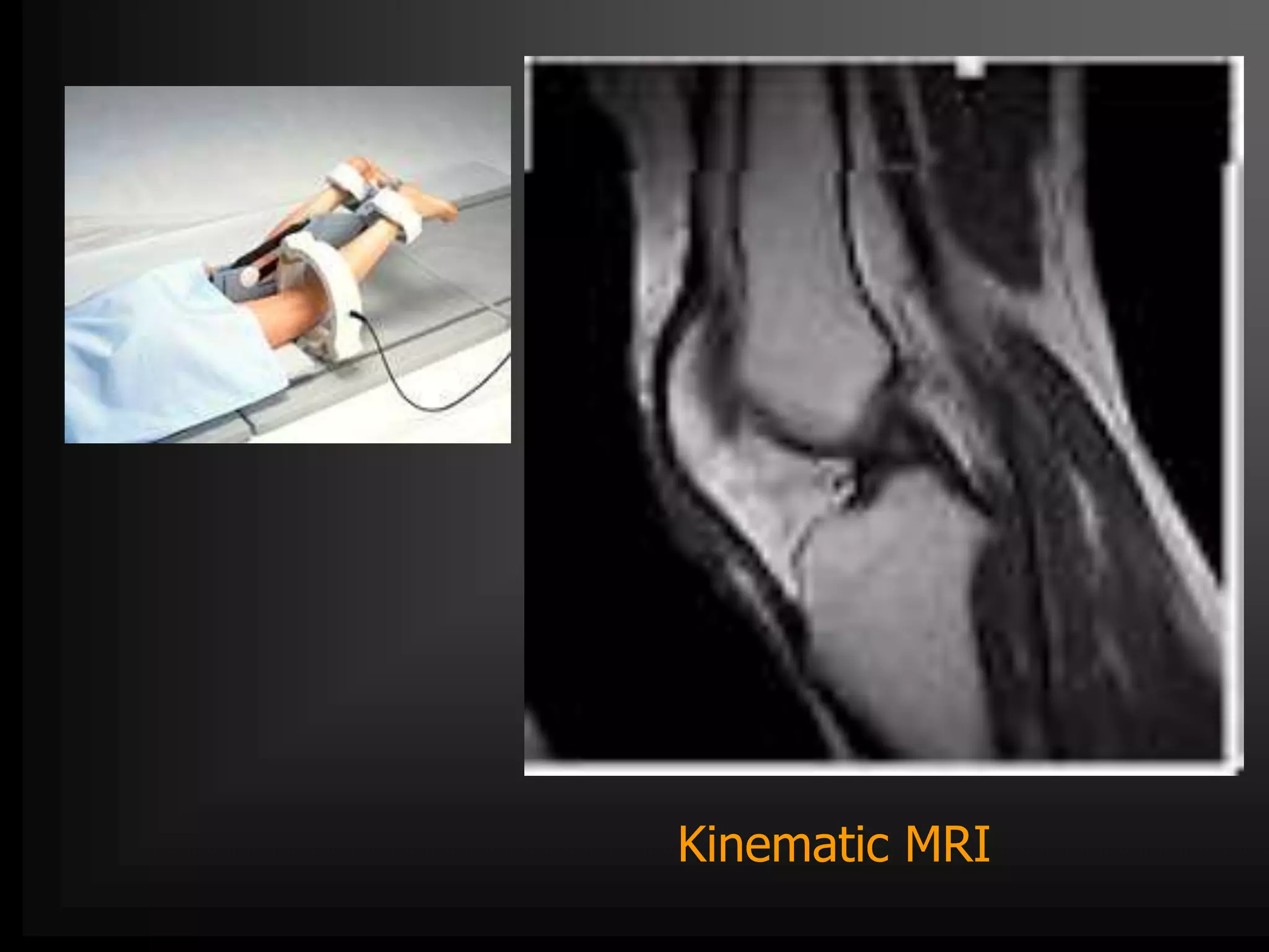 MRI of Knee joint-- hossam massoud | PPTX