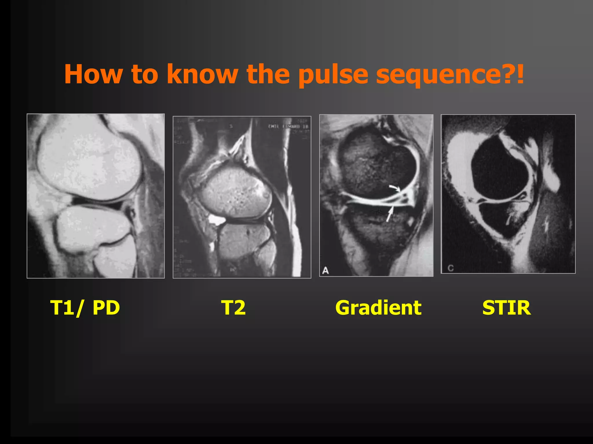 MRI of Knee joint-- hossam massoud | PPTX