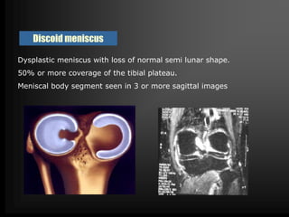 MRI of Knee joint-- hossam massoud | PPTX