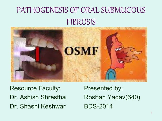 ORAL SUB MUCOUS FIBROSIS(OSMF) | PPT