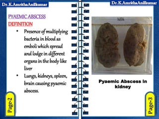 Pyaemic abscess by Dr.K.AmrithaAnilkumar | PPT