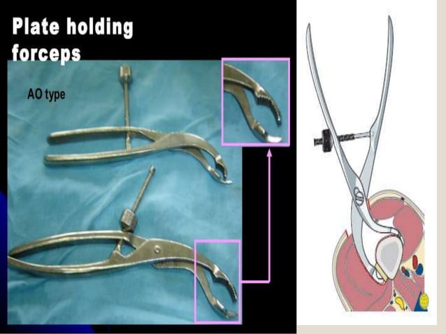 Pyelolithotomy, | PPTX
