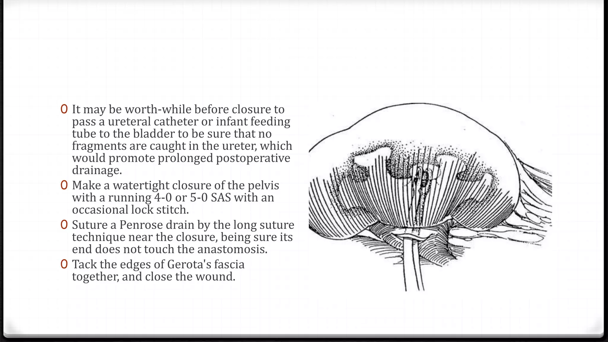 Open Pyelolithotomy | PPTX