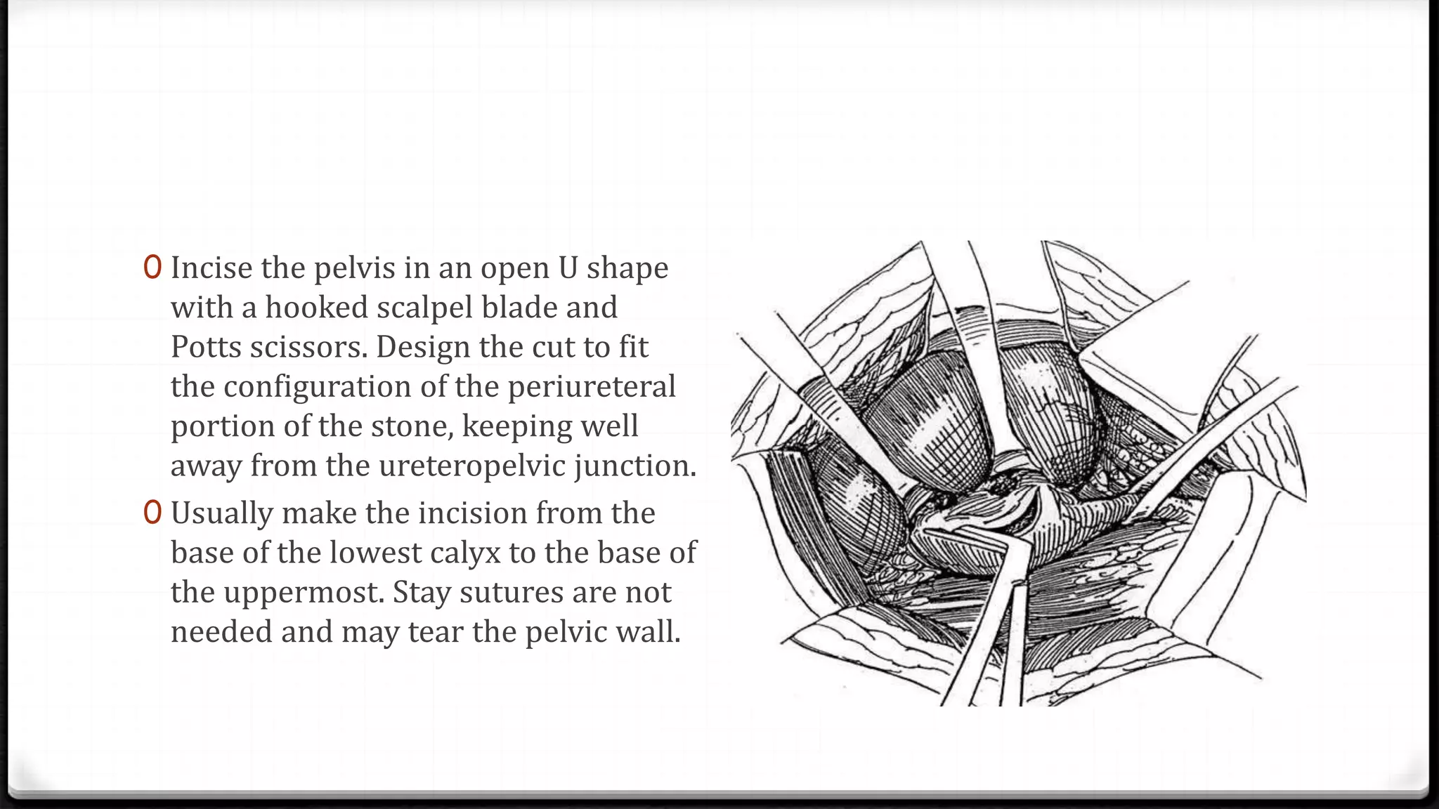 Open Pyelolithotomy | PPTX