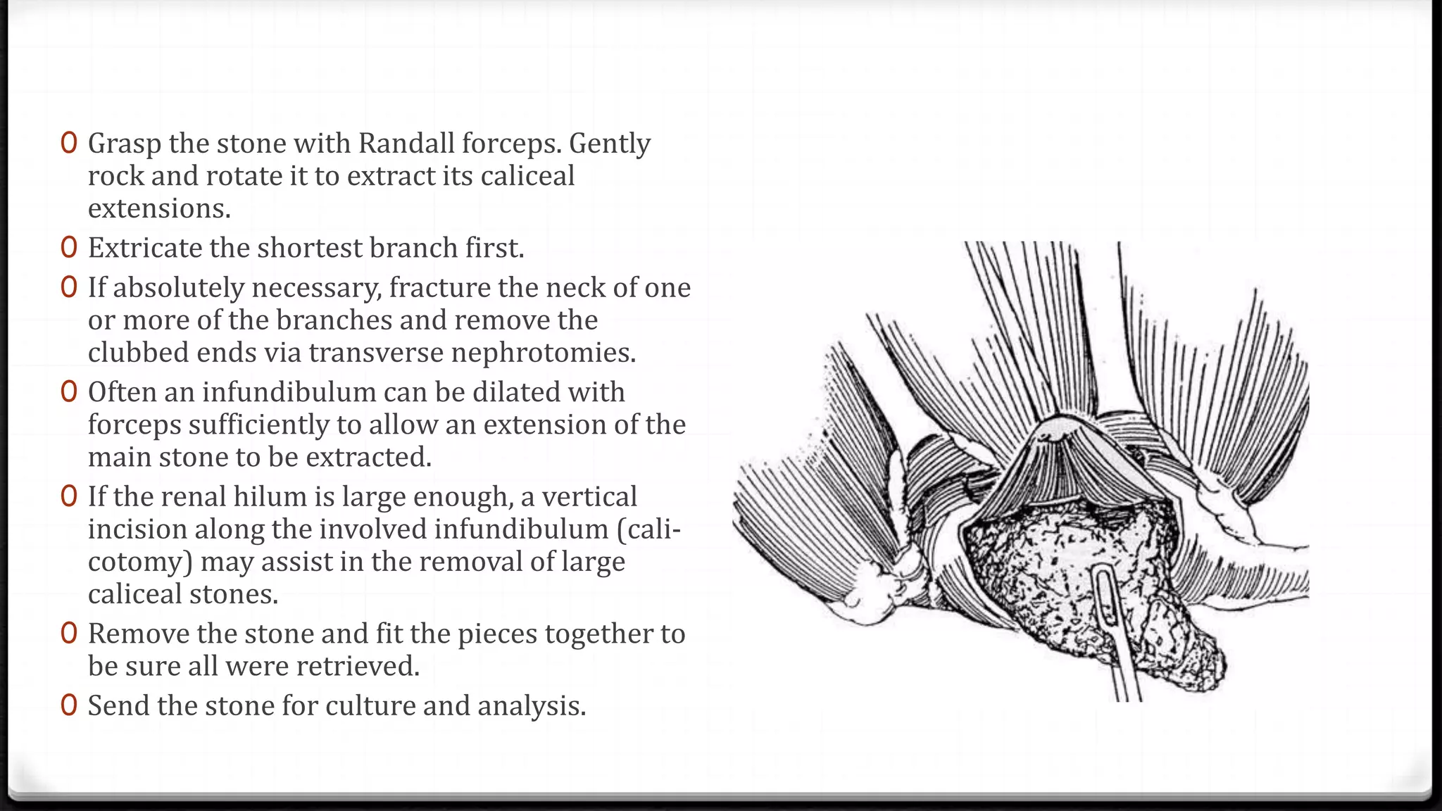 Open Pyelolithotomy | PPTX