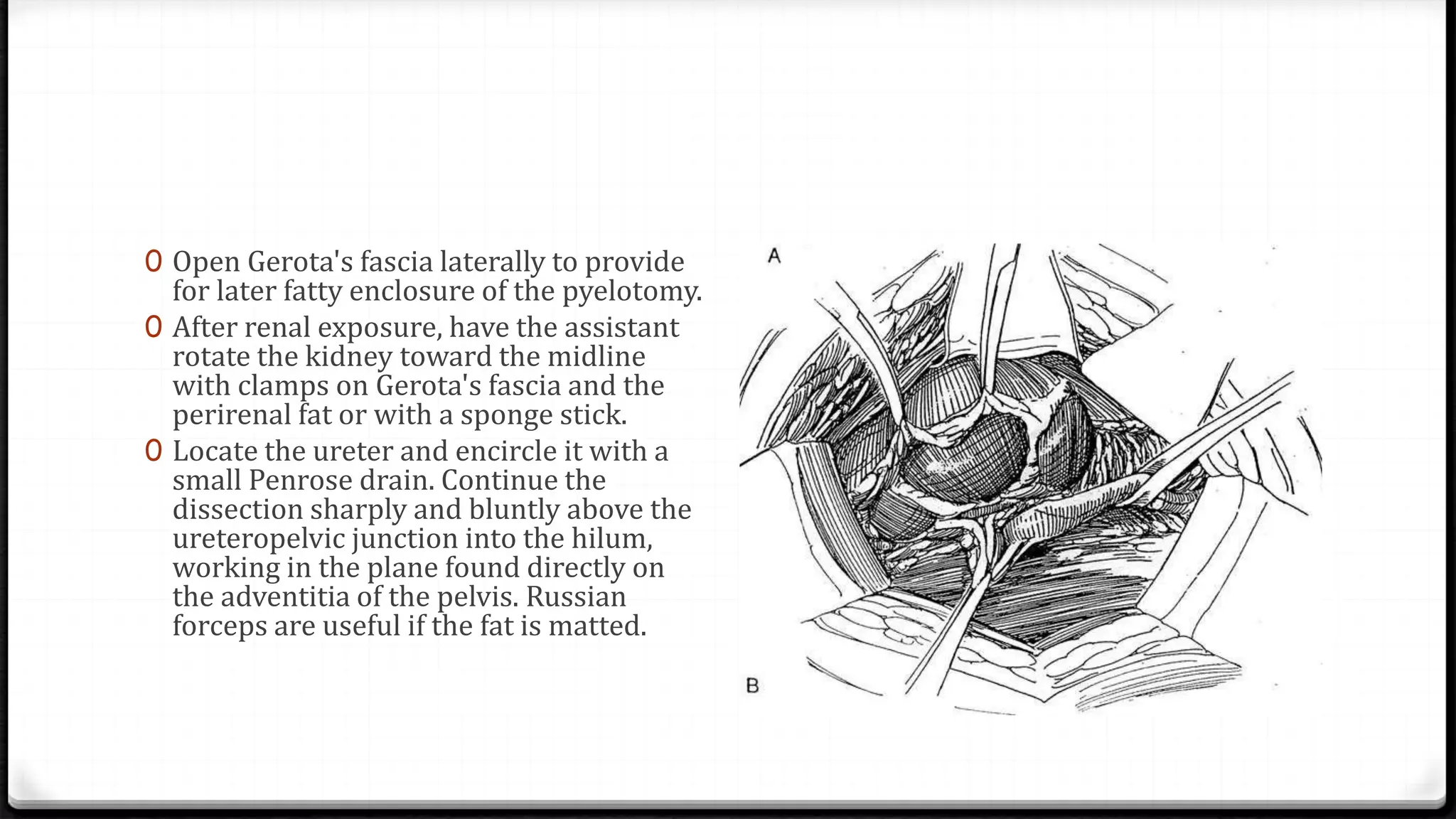 Open Pyelolithotomy | PPTX