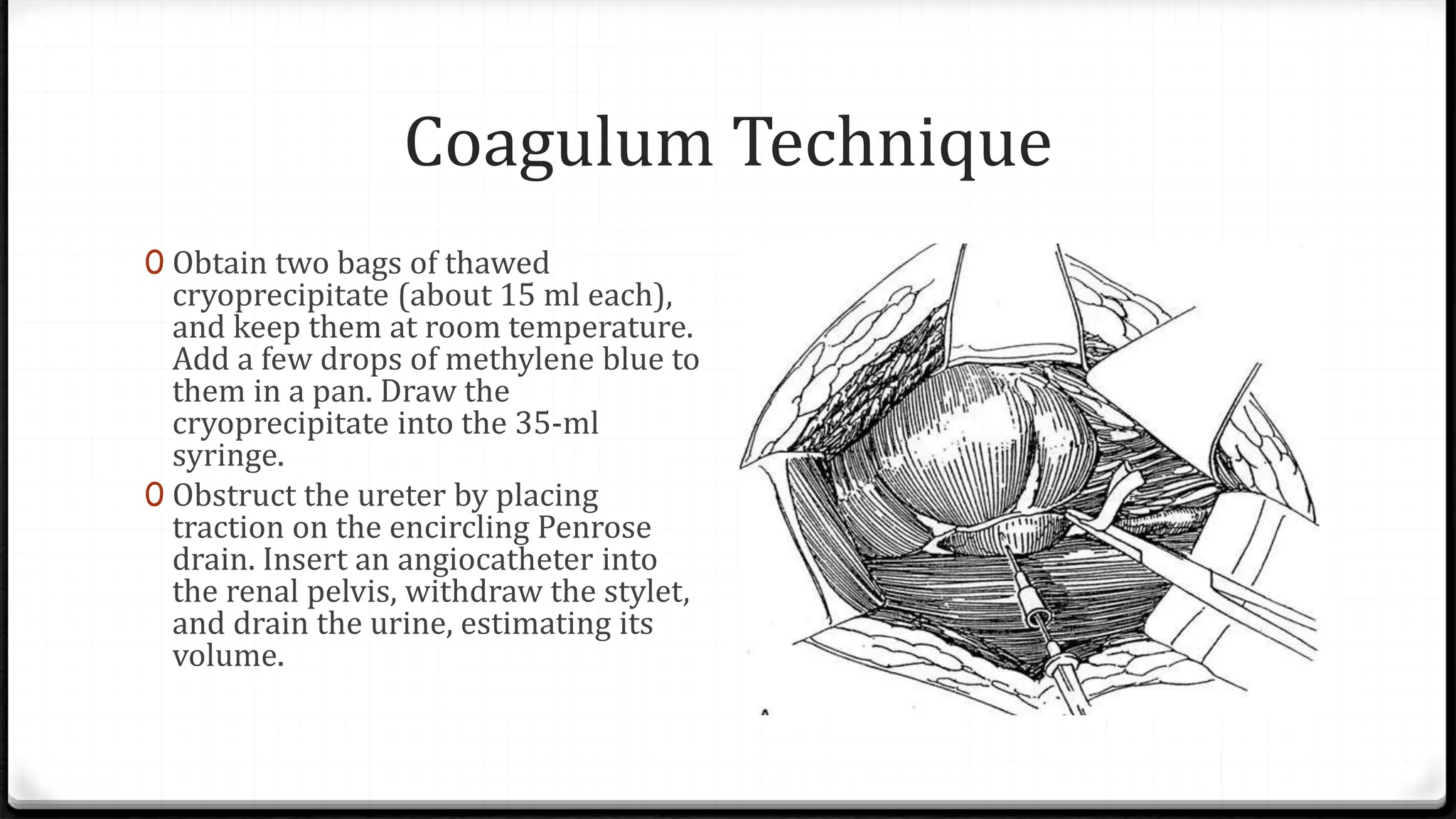 Open Pyelolithotomy | PPTX